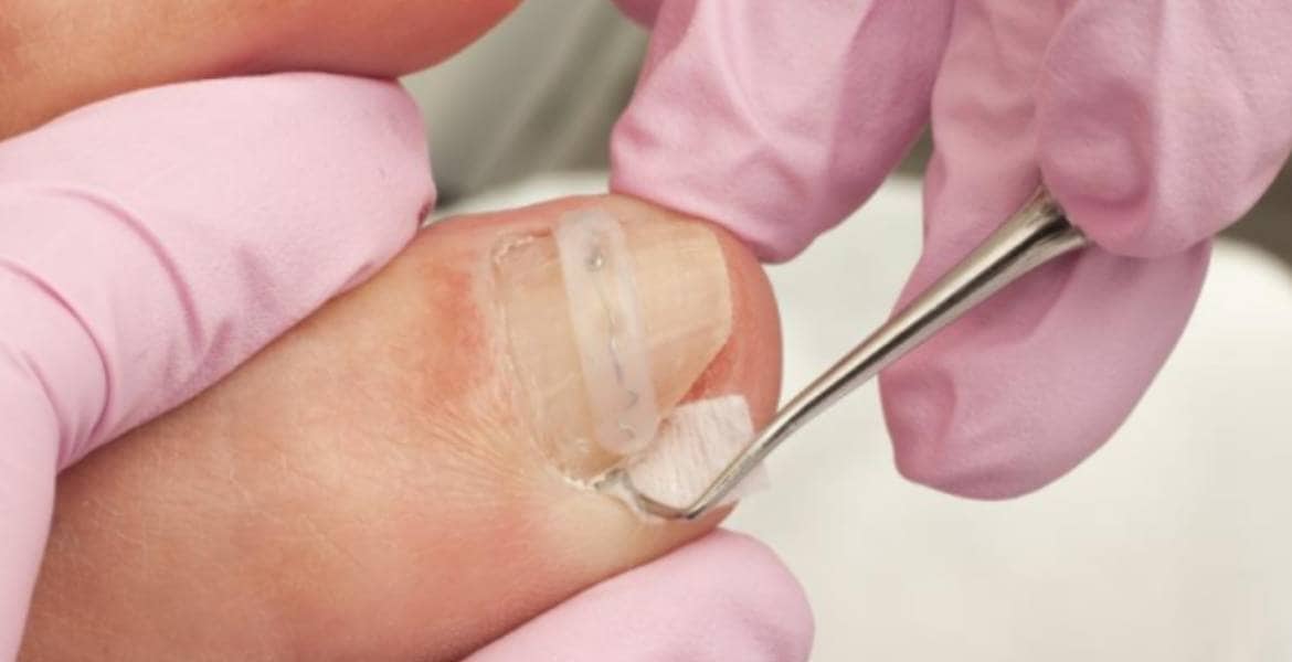 Mi Casa Footcare Offers Ingrown Toenail Removal and Treatments in Maple ...